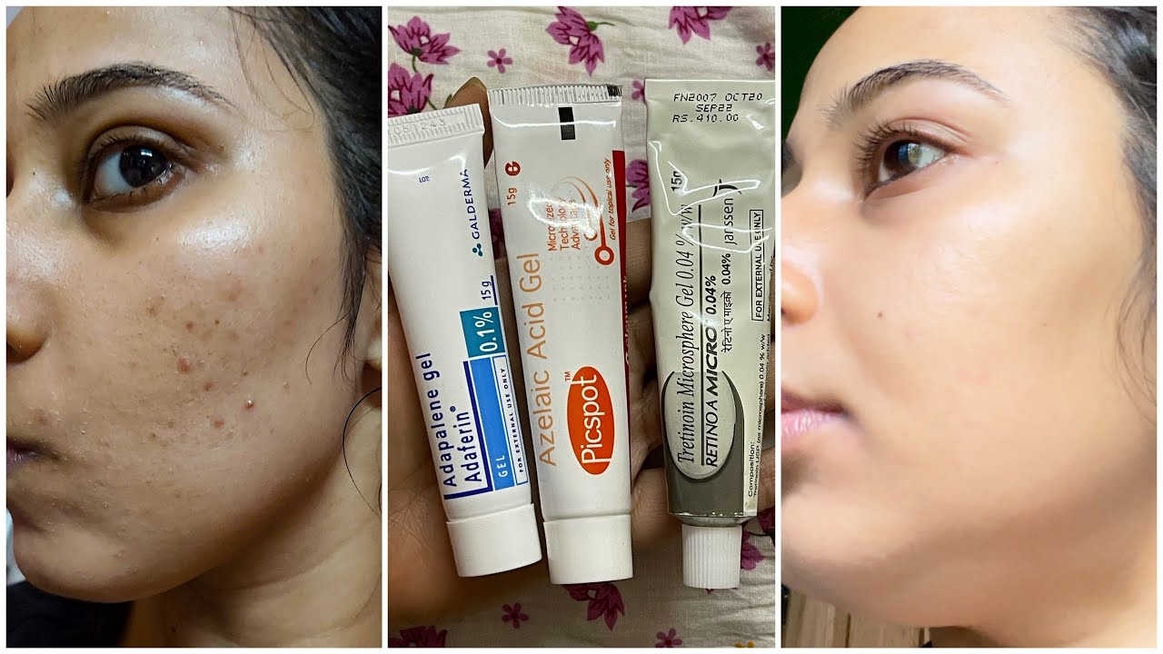 5 Best Face Cream For Pimples And Black Spots - BodyCare Blog